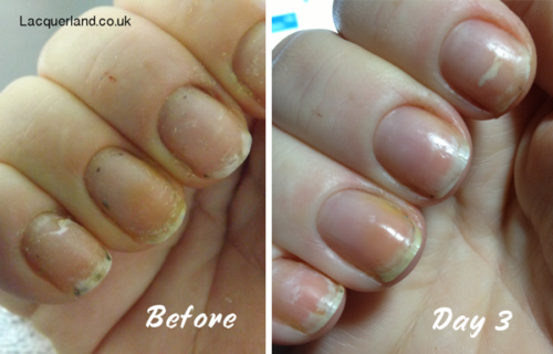 WHITE SPOTS IN NAILS – Sue’s Pure Nail Oil™ Challenge | Nail Care ...