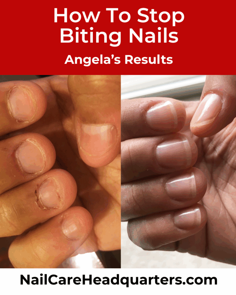 How To Stop Biting Nails – Angela’s Results | Nail Care Headquarters